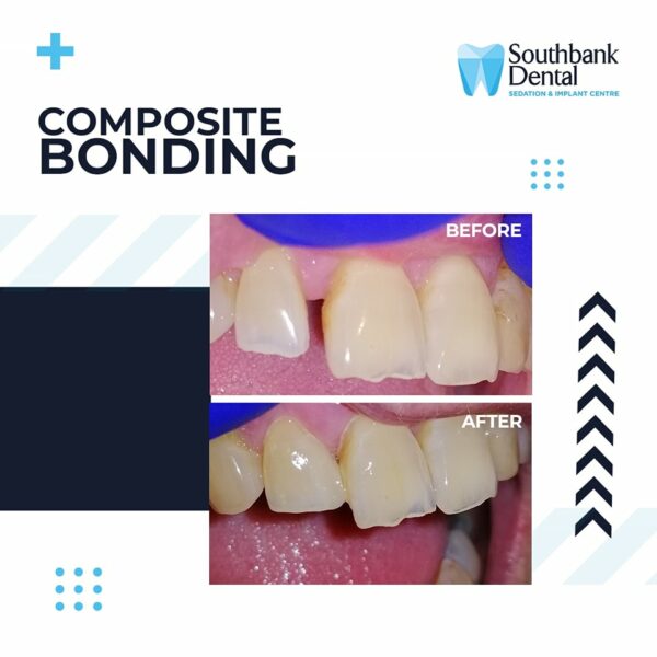 Composite Bonding – Southbank Dental