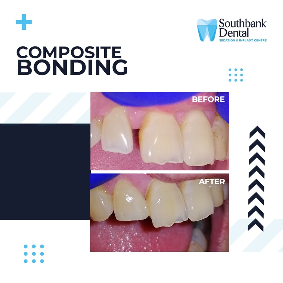 Composite Bonding – Southbank Dental